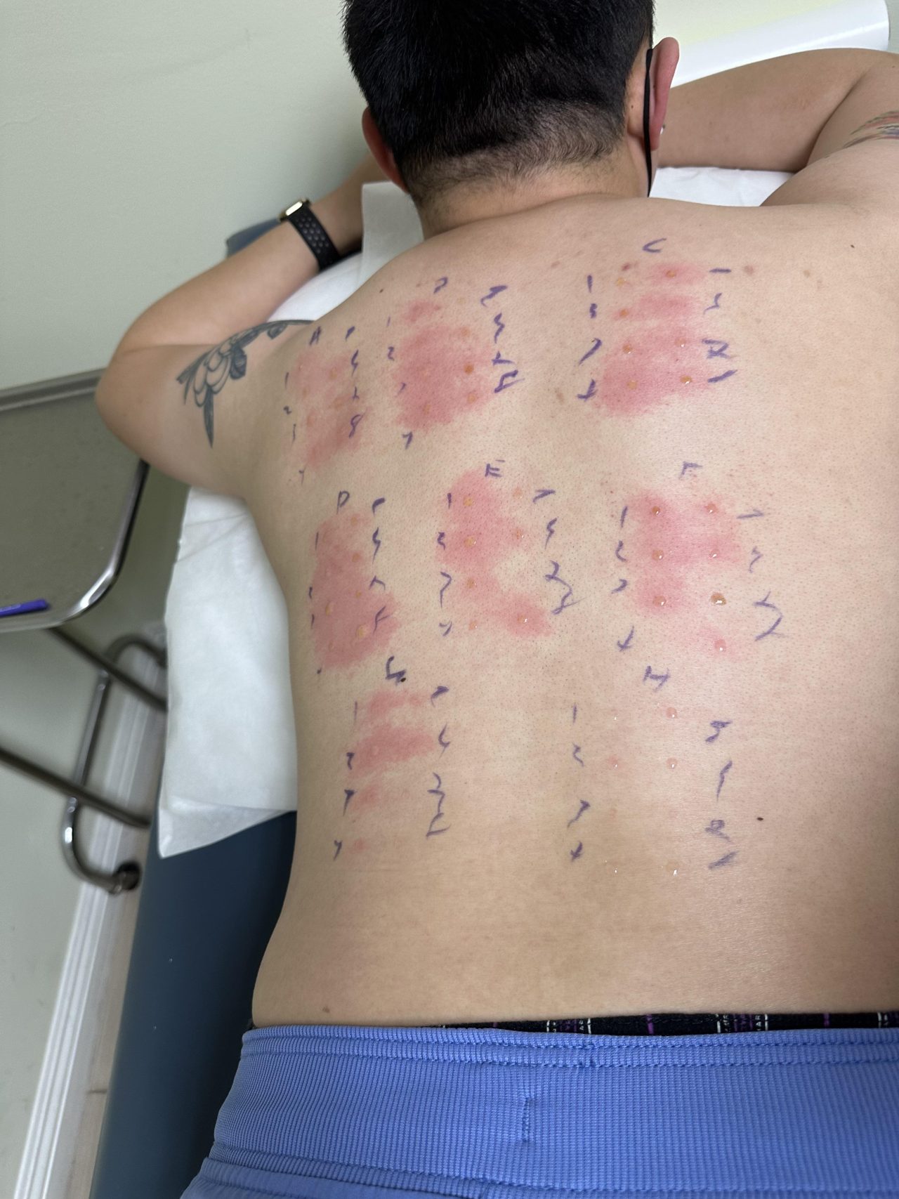 Skin Allergy Testing - Rejoice Hair Transplant